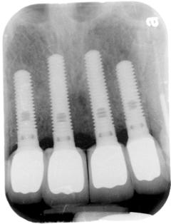 Liberty Square Dental Centre·安康牙科·案例分享·人工植牙